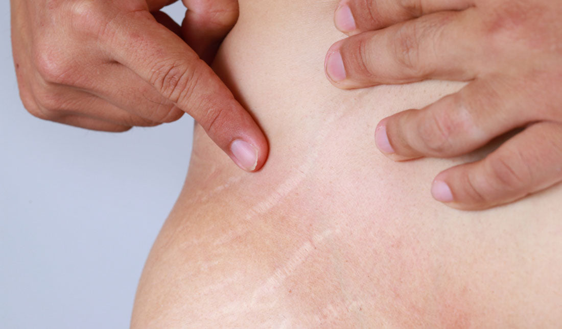 Guy’s Guide for Getting Rid of Stretch Marks – Tiege Hanley